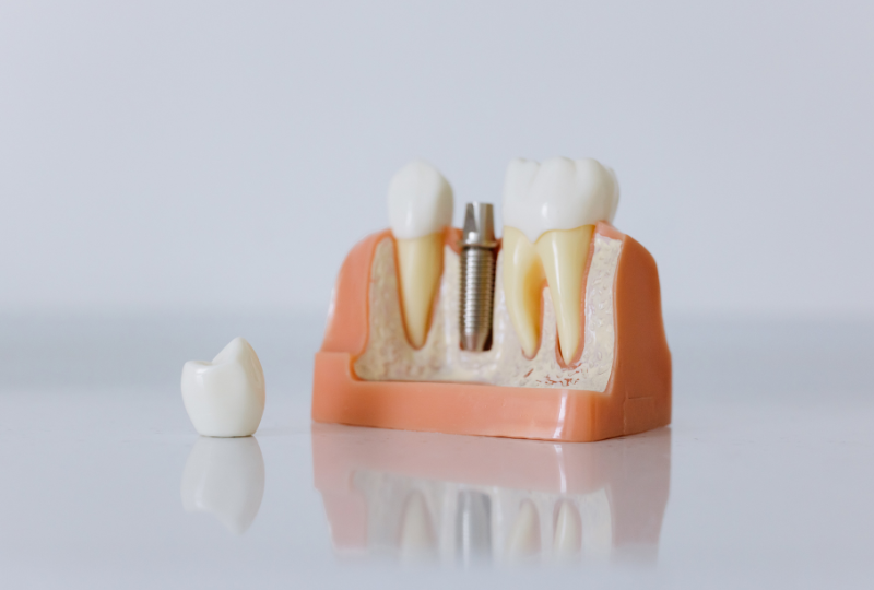 Single vs. Full-Arch Dental Implants - ReNew Dental Surgery